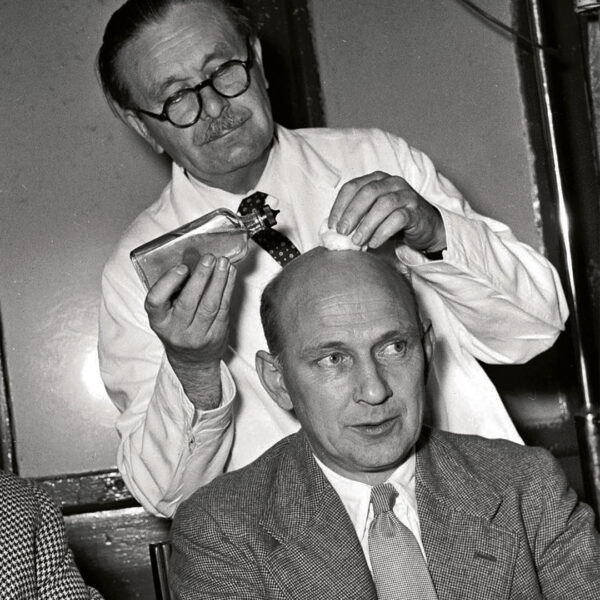 History of Hair Transplant Surgery | Hair Transplant