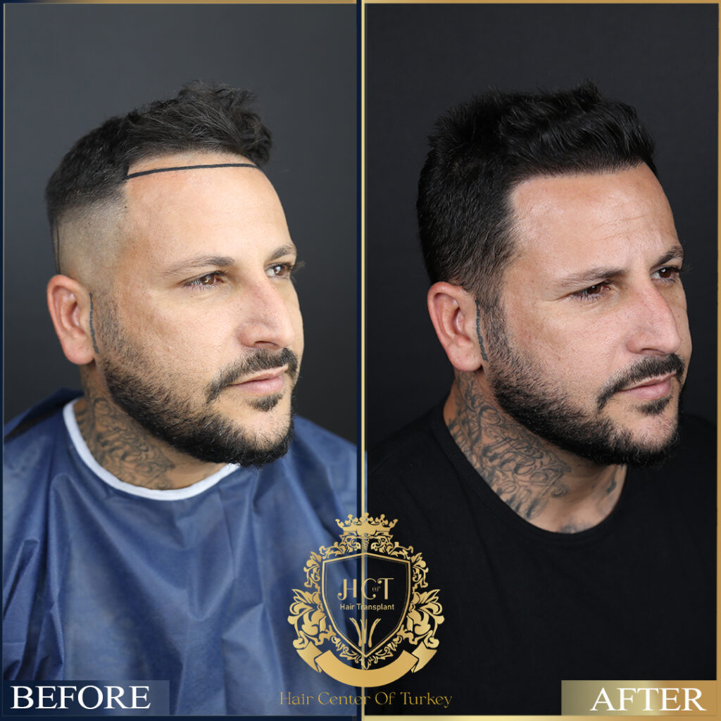 Turkey Hair Transplant Results | Hair Transplant in Turkey