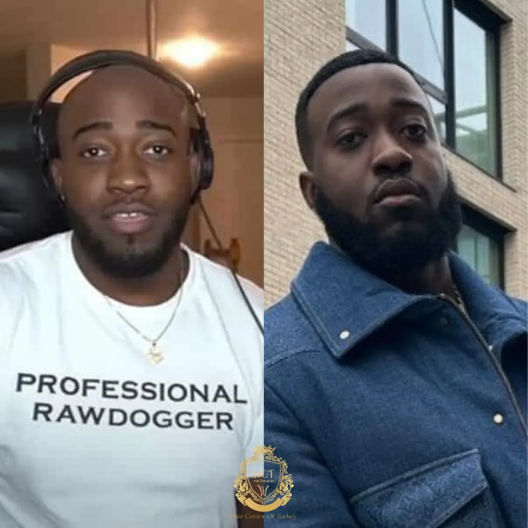 JiDion Hair Transplant: Did YouTuber Jidon Adams Really Get One? - Hair Center of Turkey