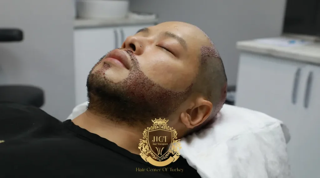 Body Hair Transplant - Hair Center of Turkey